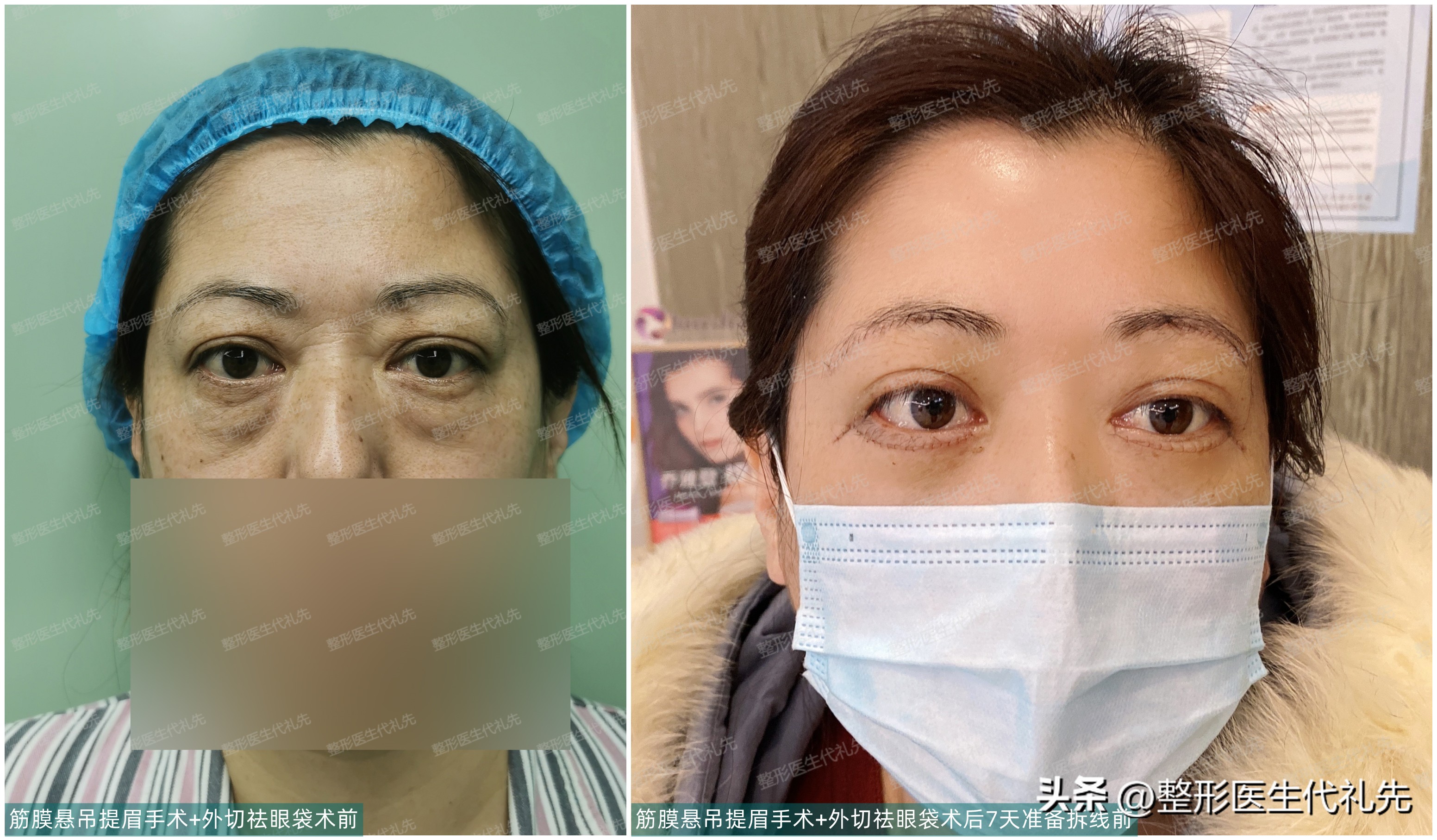 A successful eye area rejuvenation surgery needs to achieve these 5 ...