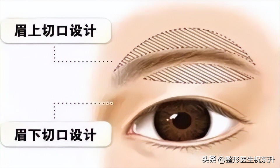 Take a look at the indications of "eyebrow lifting, double eyelid ...
