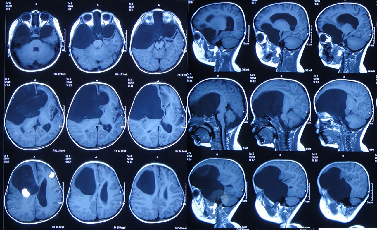 Hydrocephalus coma caused by ventriculoscopic surgery for giant ...