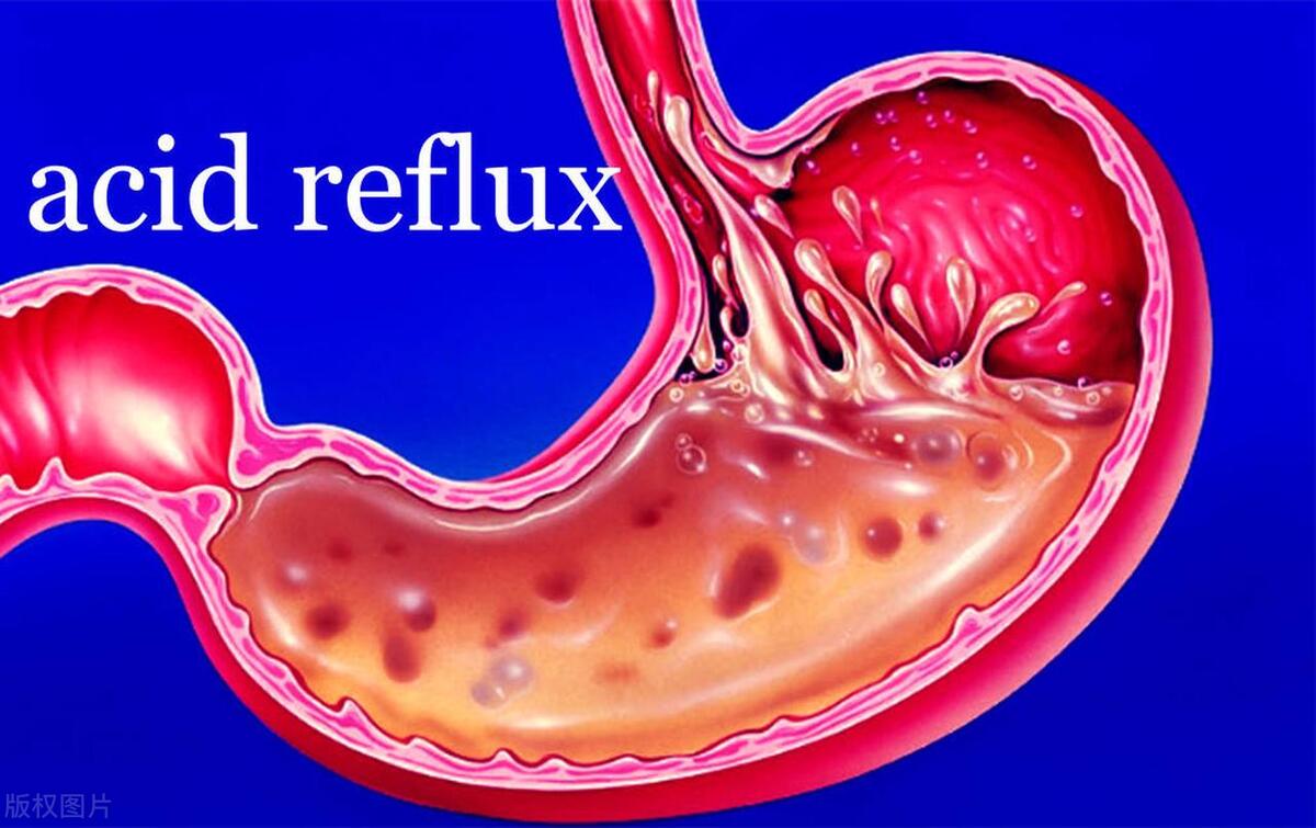 The conditioning of bile reflux: start with the digestive system! Pass ...