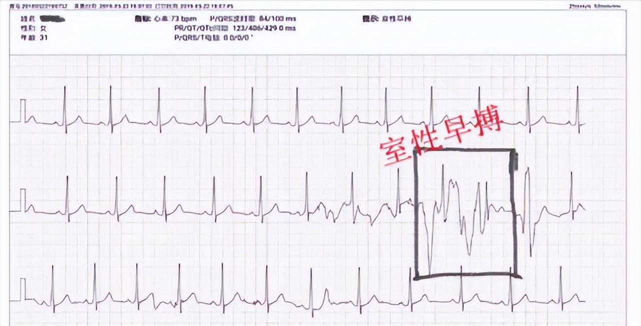 What should an ECG look like?What does the electrocardiogram mean?Take ...