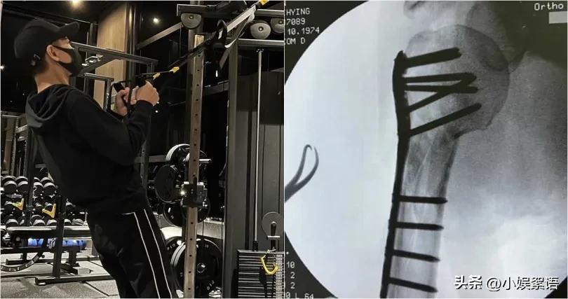 Jimmy Lin's first "titanium arm" fitness photo after the car accident ...
