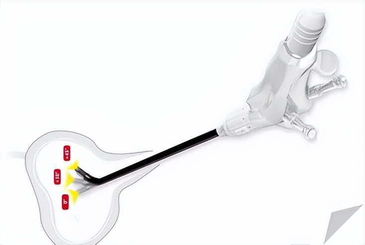 The world's first!Disposable 5mm laparoscope with autofocus approved ...