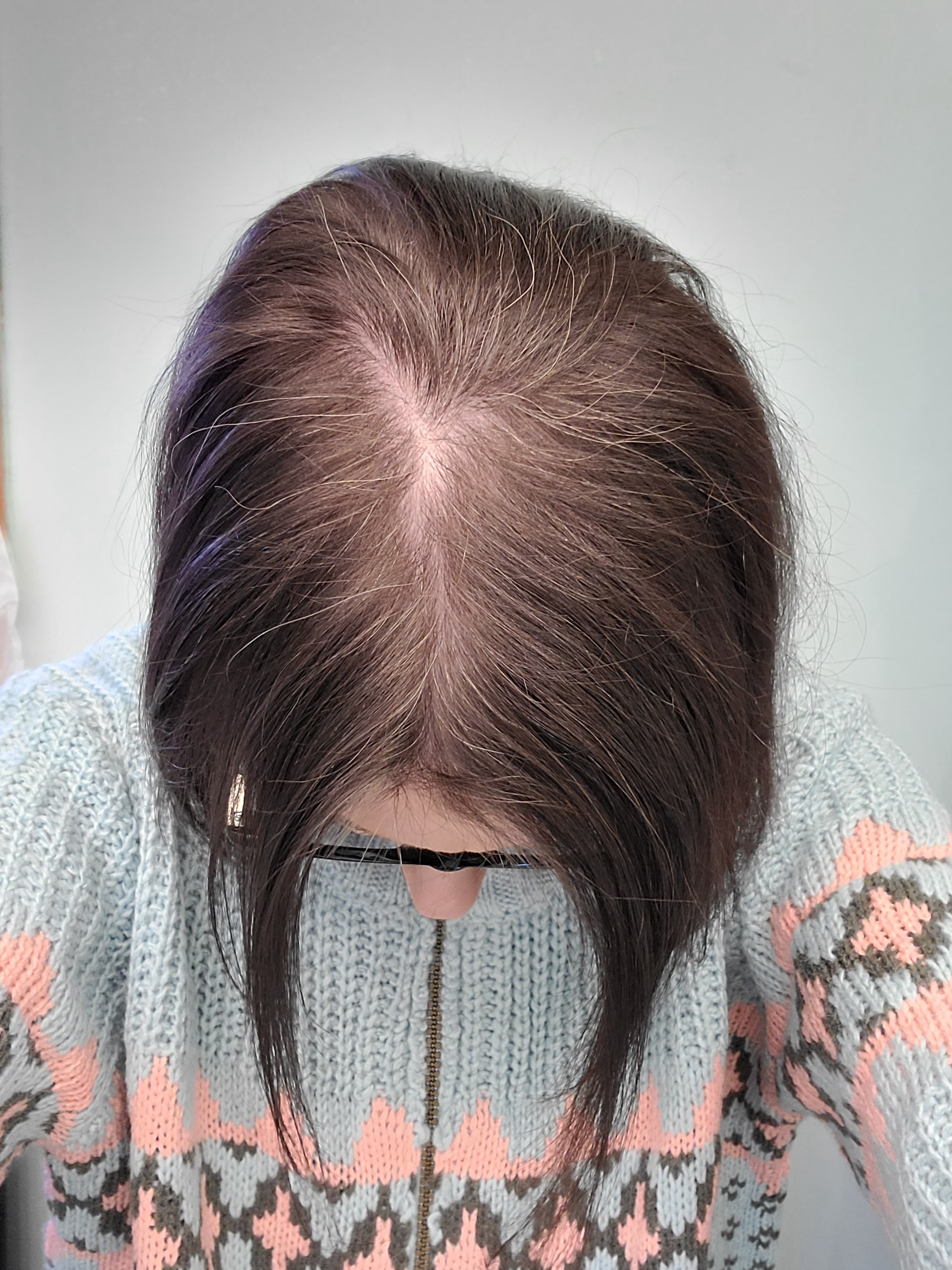 The hair gap is getting wider and wider, comparable to the "Great Rift ...