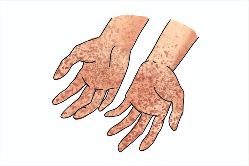 acute leukemia skin spots - iNEWS