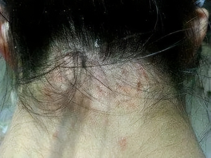 Why do I always have pimples and pustules on my scalp?This is the ...