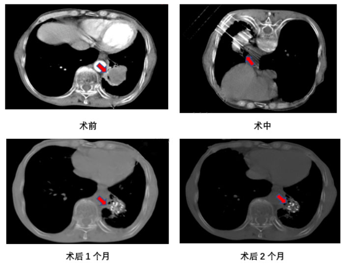 A New Method of Tumor Treatment-Radioactive Seed Implantation Therapy ...