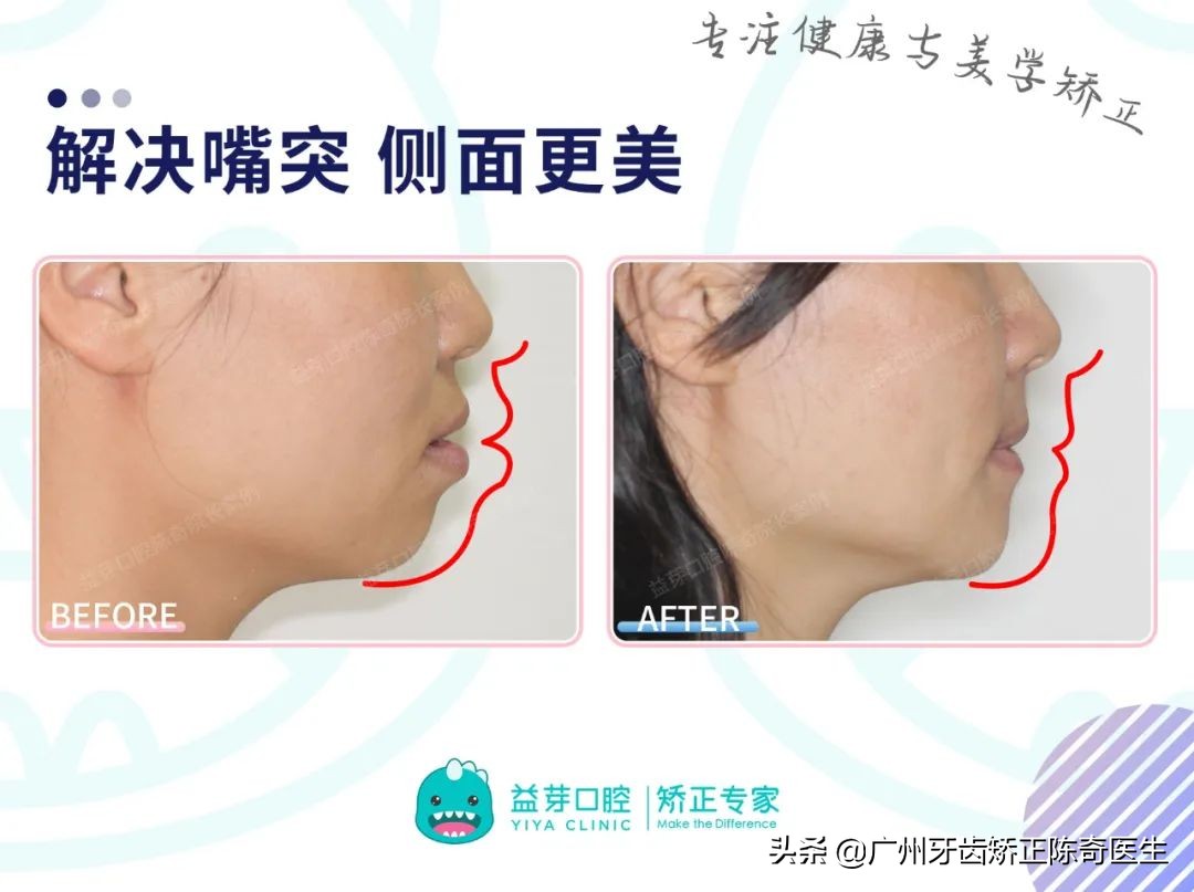 Super-difficult bony protrusion, can the chin be corrected in an older ...