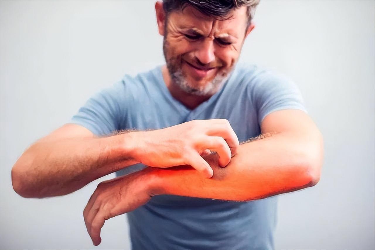 Keloids are always painful and itchy, why? How to alleviate it? - iMedia