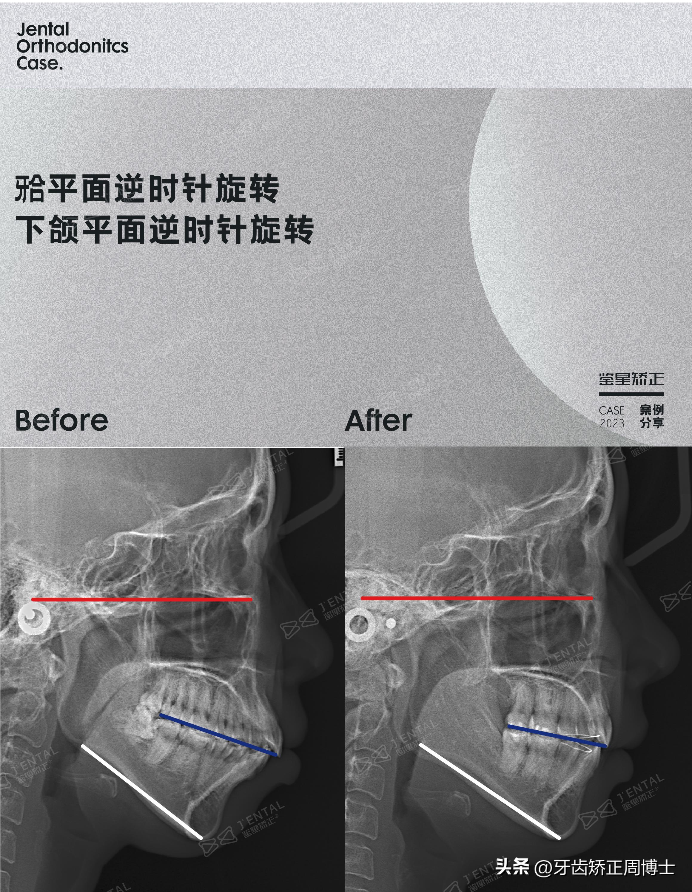 8 bone nails with upper and lower jaw reverse rotation, poor mandible ...