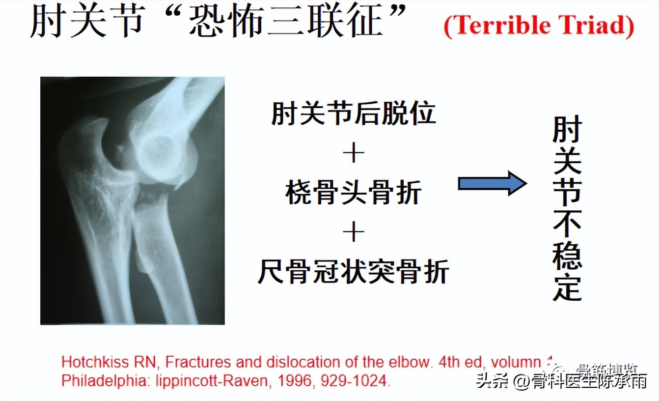 Treatment of the "terrible triad" of the elbow - iNEWS