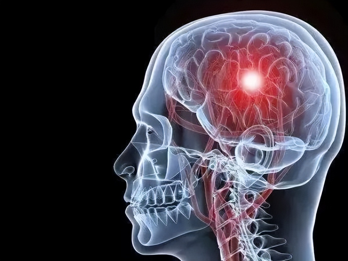 Chinese people are most prone to cerebral infarction, and atrial ...