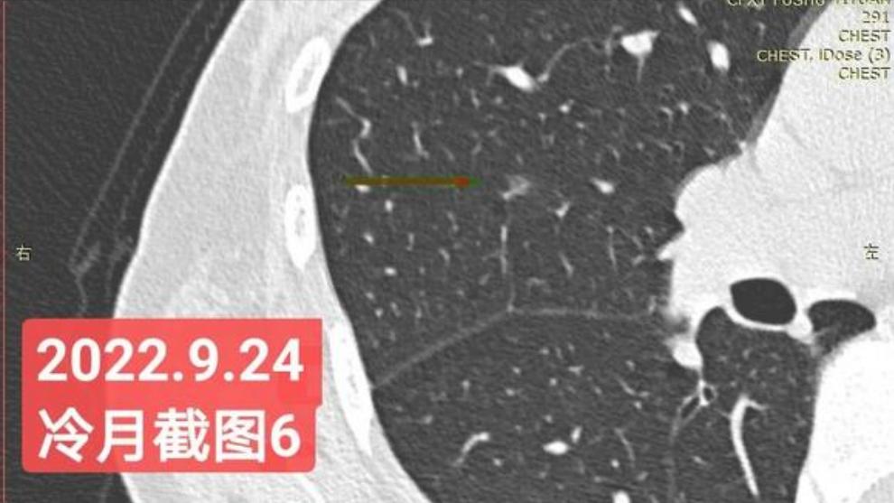 7mm high-risk pulmonary nodules cannot be cured and can only be treated ...
