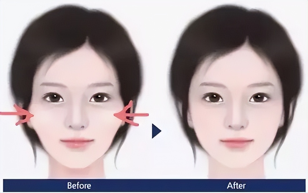 What are the ways to improve the protruding cheekbones? - iNEWS