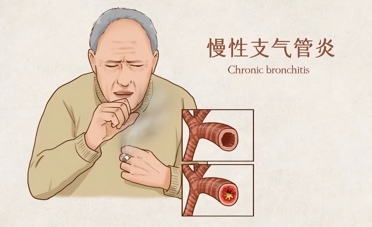 In addition to smoking, what other environmental factors may lead to ...