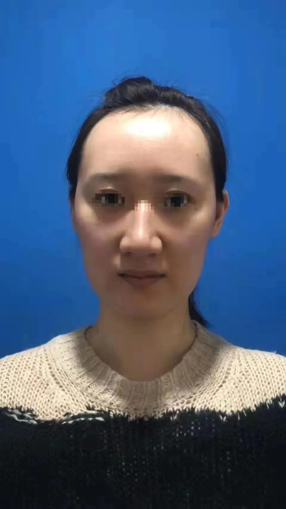 At the age of 43, I just wanted to look younger, so I did a minimally ...