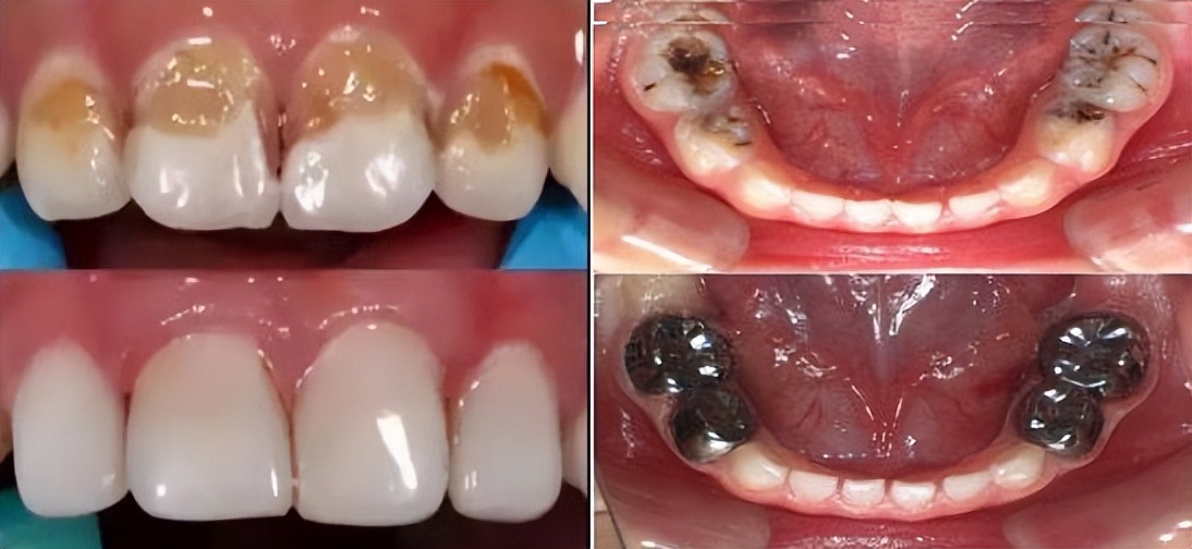 Pre-formed crowns for primary teeth: braces for children - iNEWS