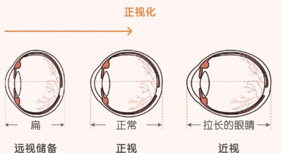 2.5-year-old children have insufficient hyperopia reserves and are not ...