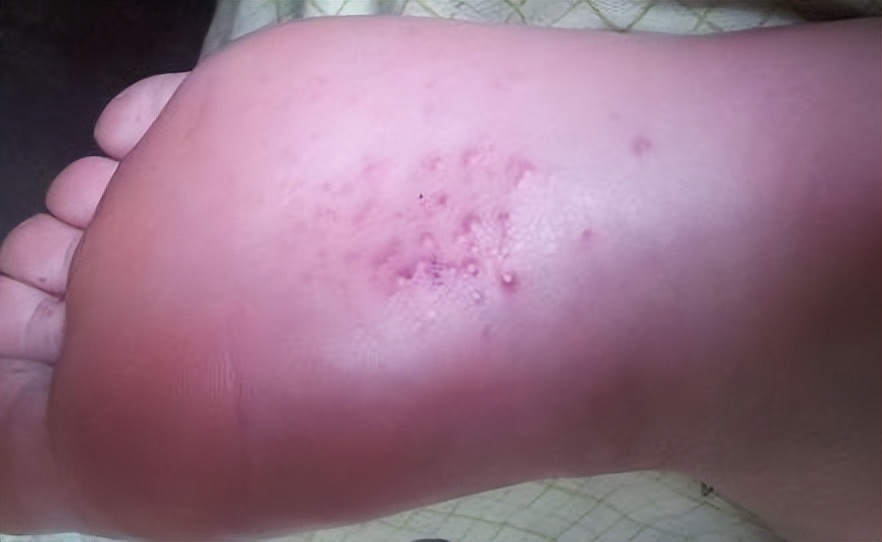 What is tinea pedis and how to treat it effectively - iNEWS