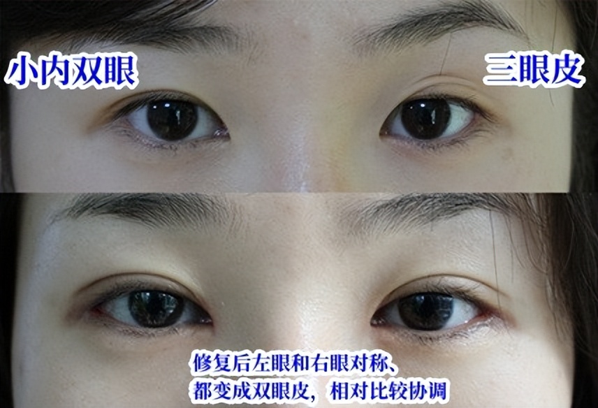 Why do double eyelids become triple eyelids? - iMedia