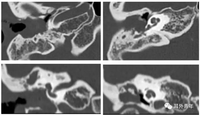 Common Abnormal Temporal Bone CT Summary - iNEWS