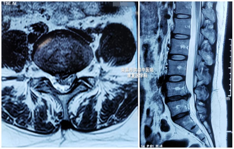 Non-surgical treatment of lumbar disc herniation, learn about it - iMedia