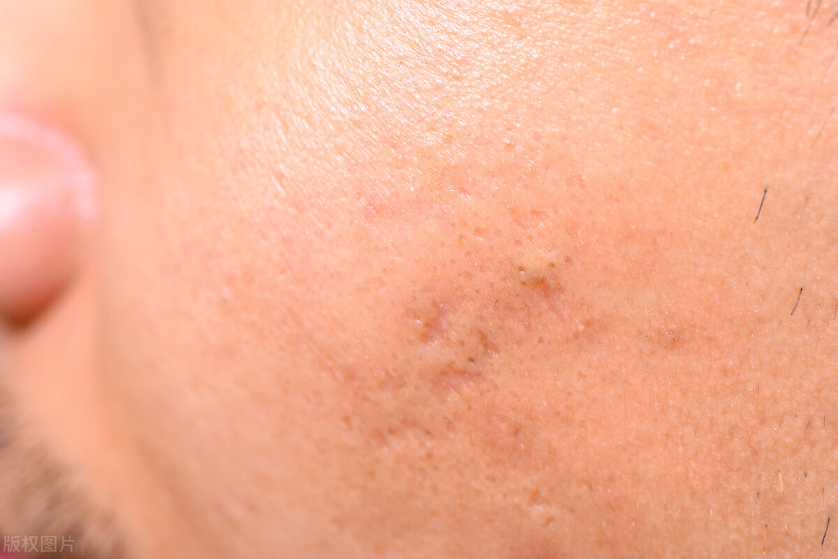 Don't do these 5 things in the process of acne scar repair - iMedia