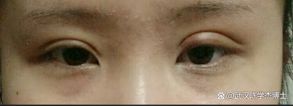 Why is your double eyelid "fake one eye"?Let a professional doctor ...