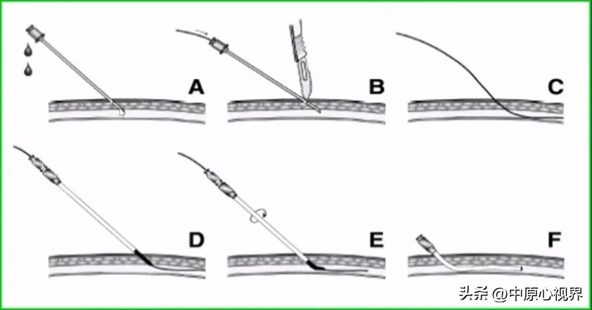 Radial artery puncture II - iNEWS