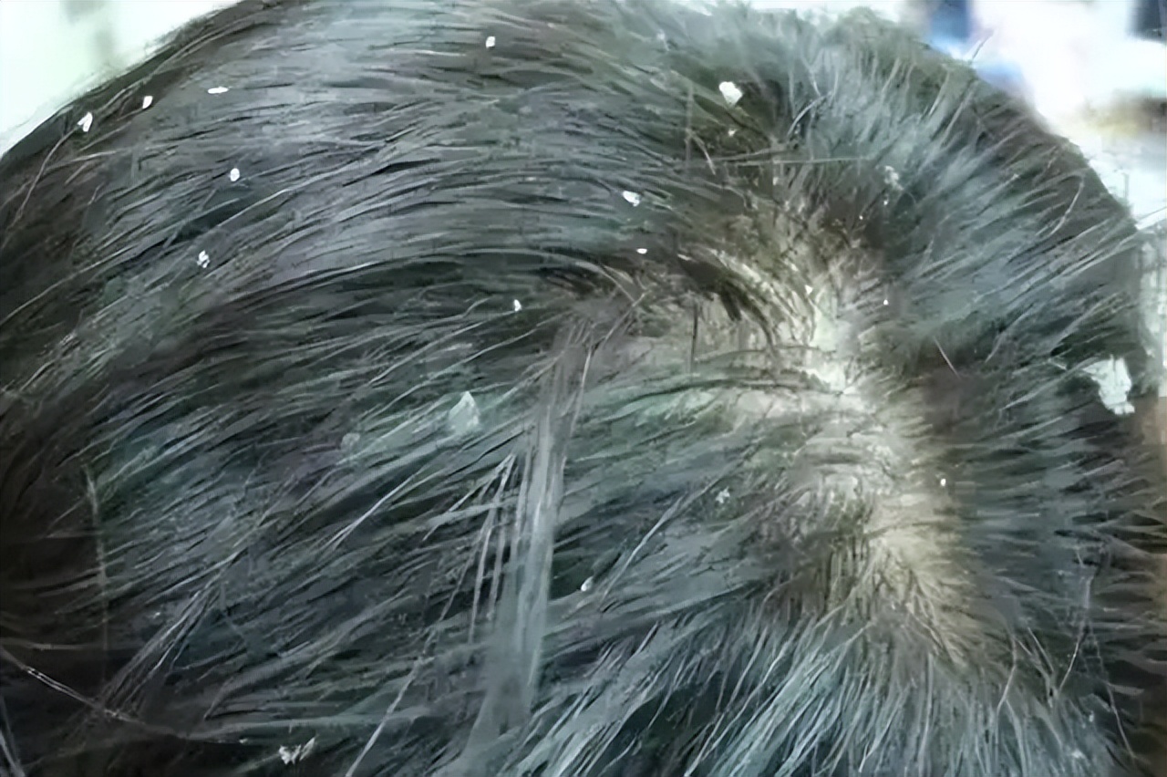 Yunnan scalp management: why there is dandruff?How to get rid of ...