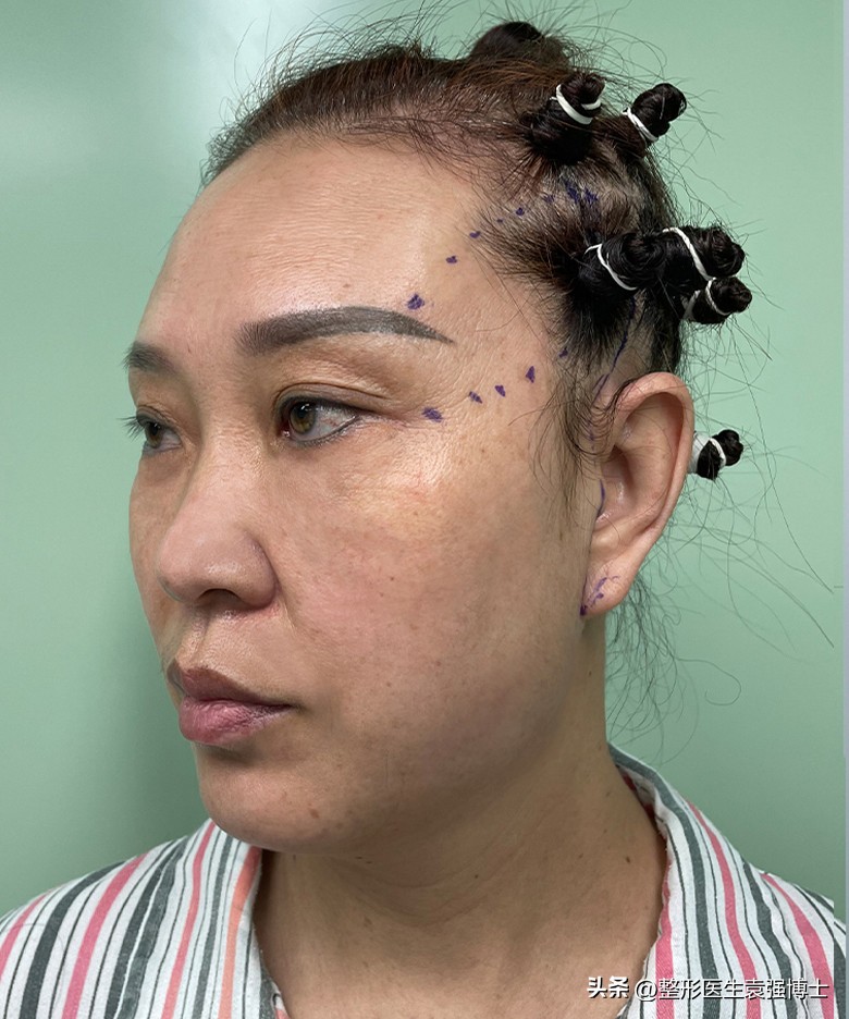 A 50-year-old woman did a big facelift, didn't dare to go out for 7 ...