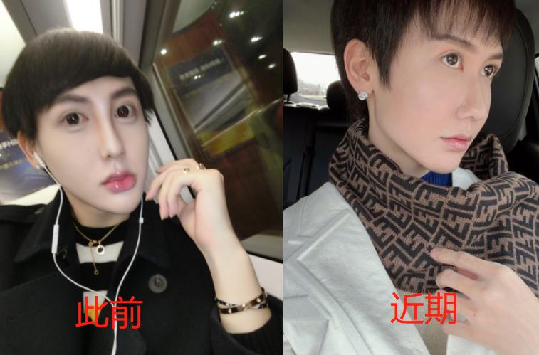 Net red Zhou Chuna spent 4 million plastic surgery!After five years of ...