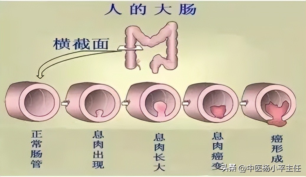 Gastrointestinal polyps, will everything be all right after removal ...