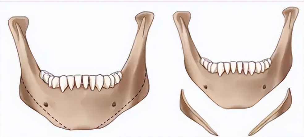 What is the difference between mandibular angle grinding and osteotomy ...