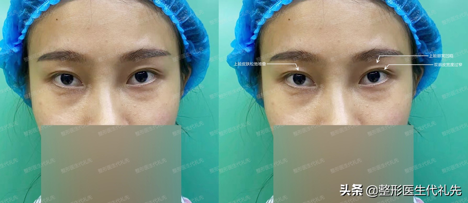 Sunken eye sockets and narrowed double eyelids, the doctor will take ...