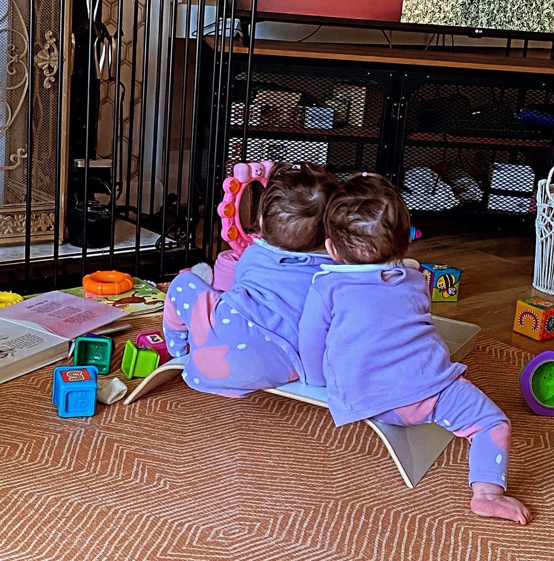 The conjoined twins in Northern Ireland were successfully separated ...