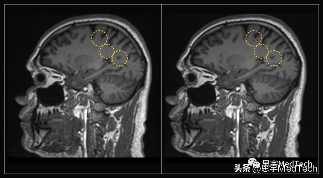 Approved by FDA! AI-Enhanced Magnetic Resonance Imaging - iNEWS