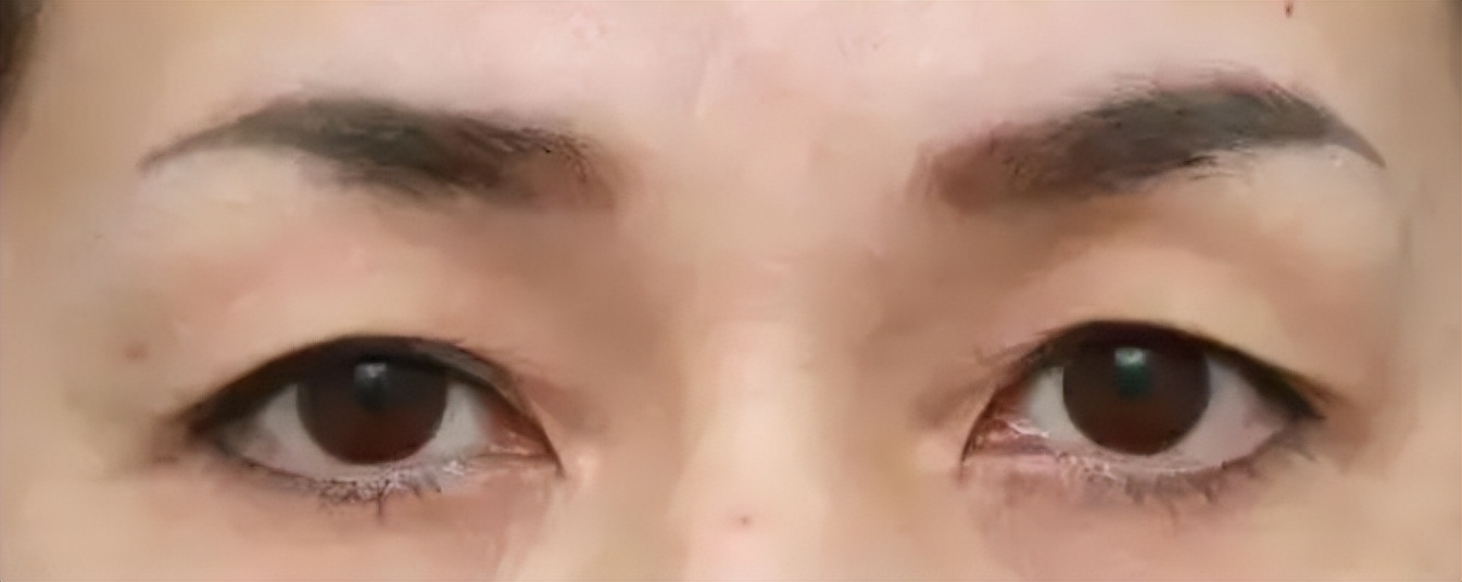 Droopy eyelids look 10 years older!How to choose eyebrow lift and ...