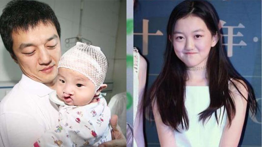 Faye Wong spent millions to cure her daughter's cleft lip! Why is the face getting longer and ...