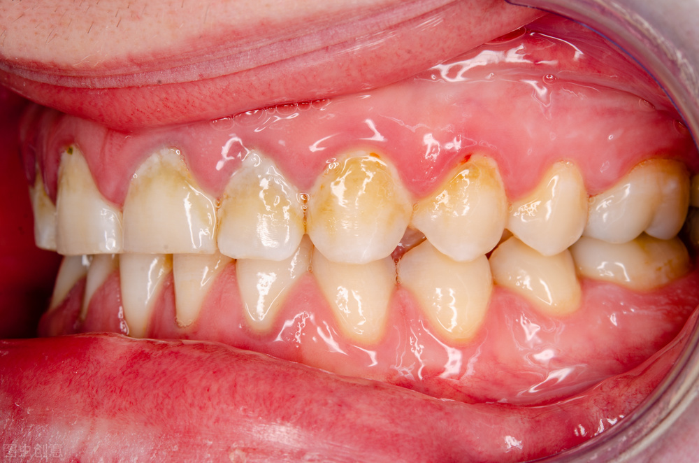 People who often do these things have basically receded gums - iNEWS