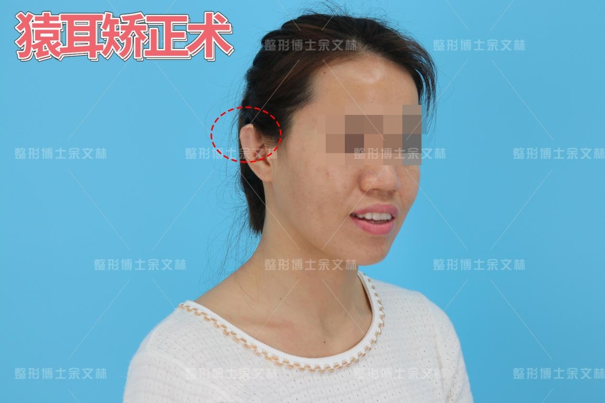 "Ape Ear Case Study" Are Elf Ears really good-looking?Miss Elf Ears ...