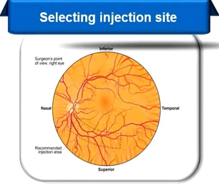 Talking about Subretinal Gene Therapy Drug Injection: Facing the ...
