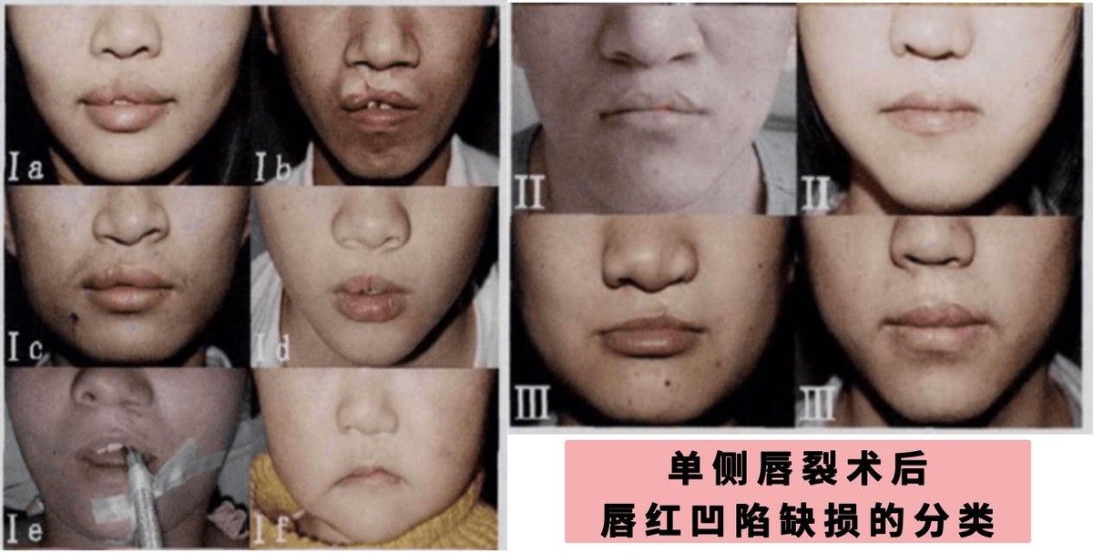 What should I do if a piece of lips is missing after Cleft Lip Repair ...
