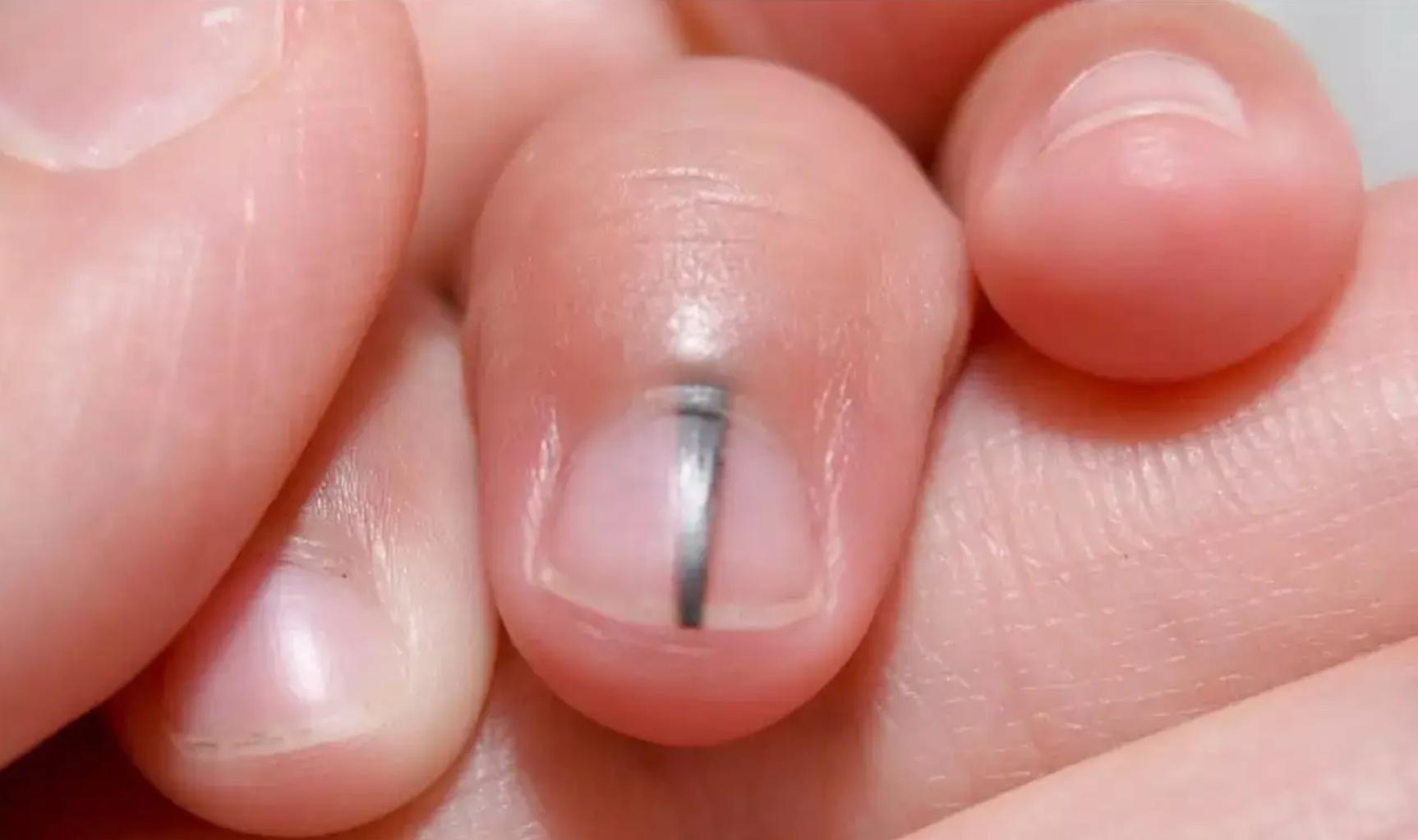 Cancer in the body, nail prophet?If the nails grow into 4 shapes, it ...