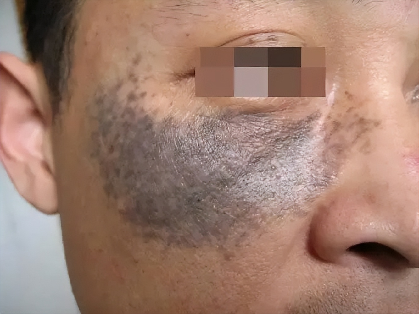 How to remove birthmarks on face?How to get rid of birthmarks fast - iNEWS