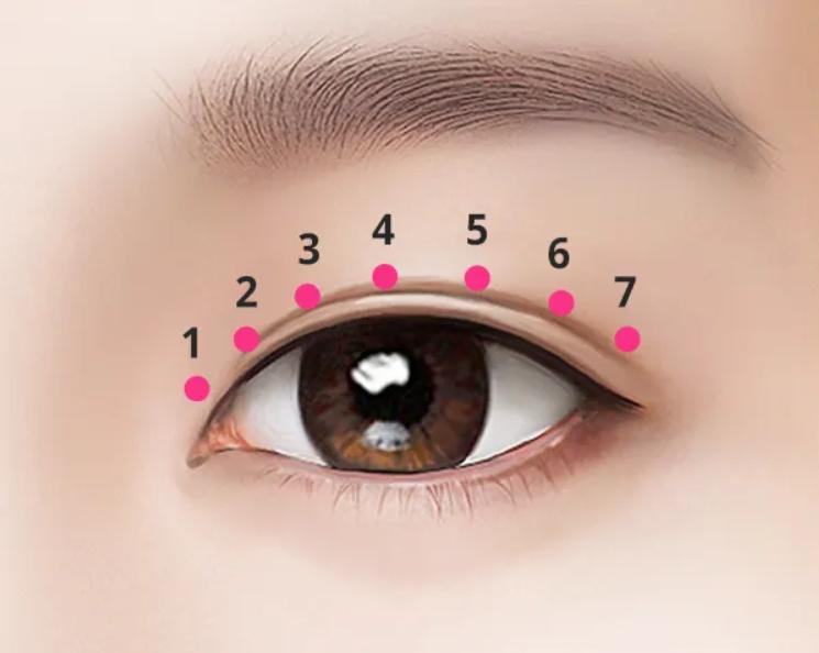 What thread is used to bury the double eyelid? - iNEWS