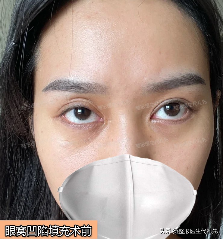 Autologous fat glue filling eye socket depression, detailed analysis ...