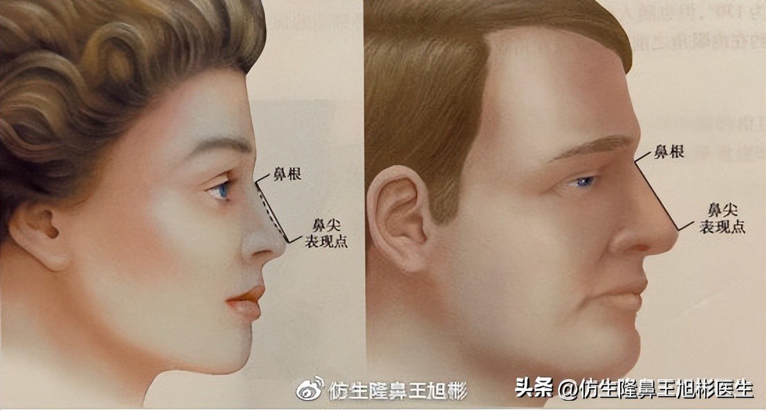 What is a hump nose and does it need to be corrected? - iNEWS