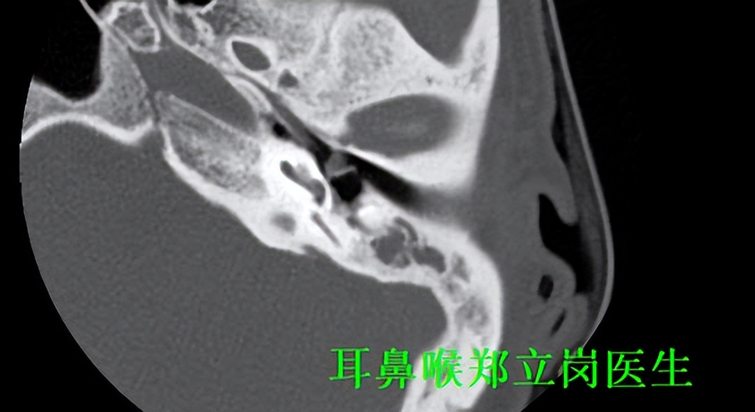 Perforated eardrum, poor hearing, is surgery still useful? - iNEWS