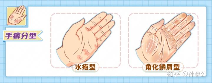 Can hand fungal infections be cured?How to treat it? - iNEWS